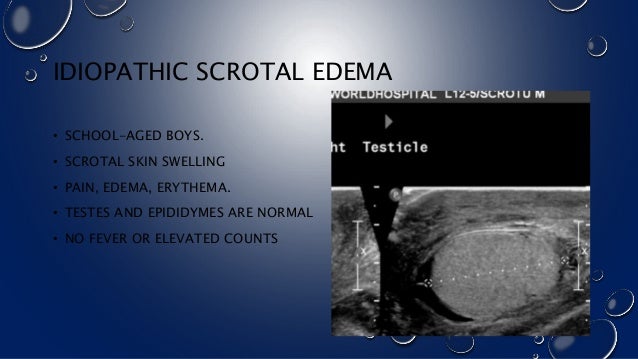 Ser 2016 acute scrotum 1 dr.amitha