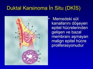 DKIS ve LKISda mammografi - ultrasonografi | PPT