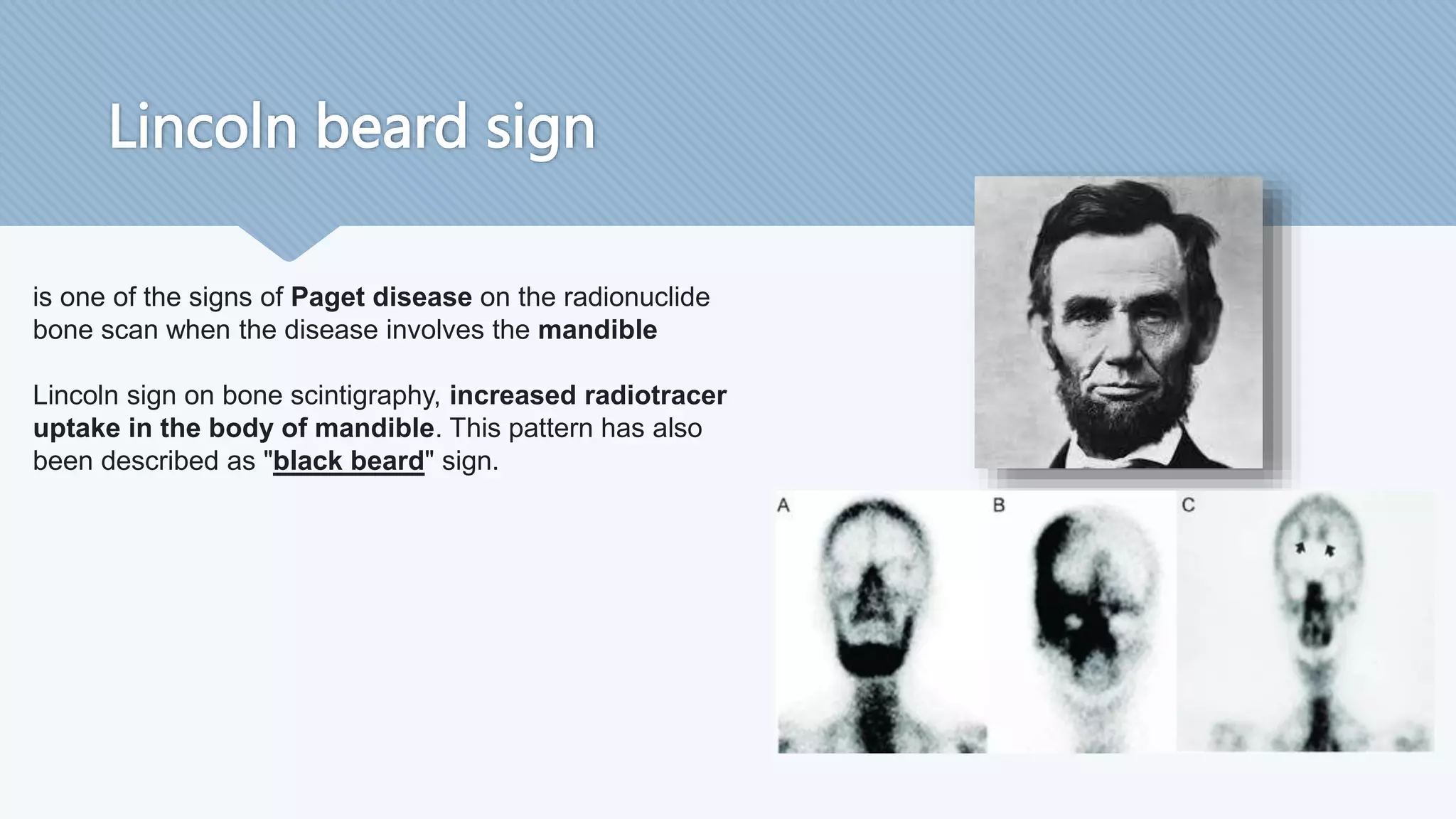 Paget's Disease | PPTX