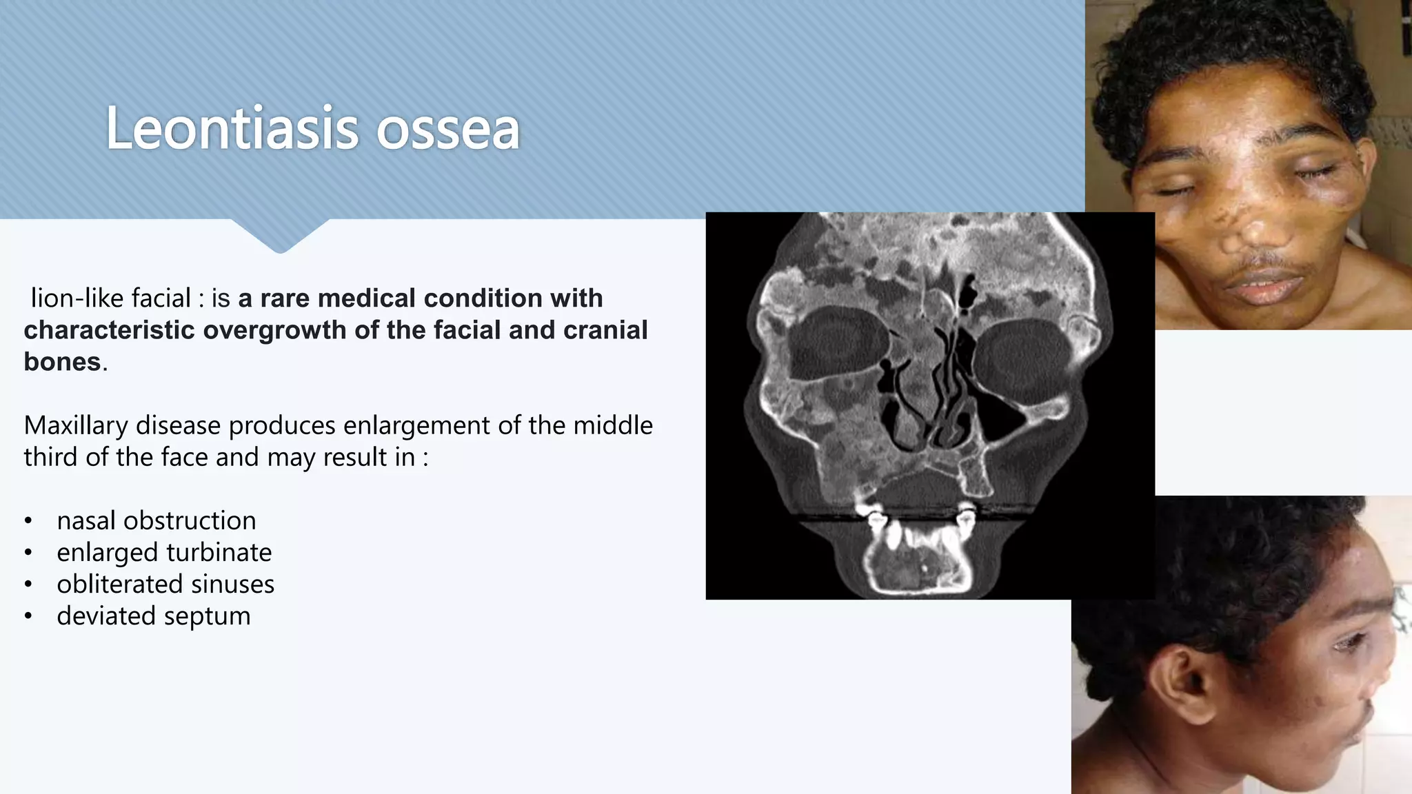 Paget's Disease | PPTX