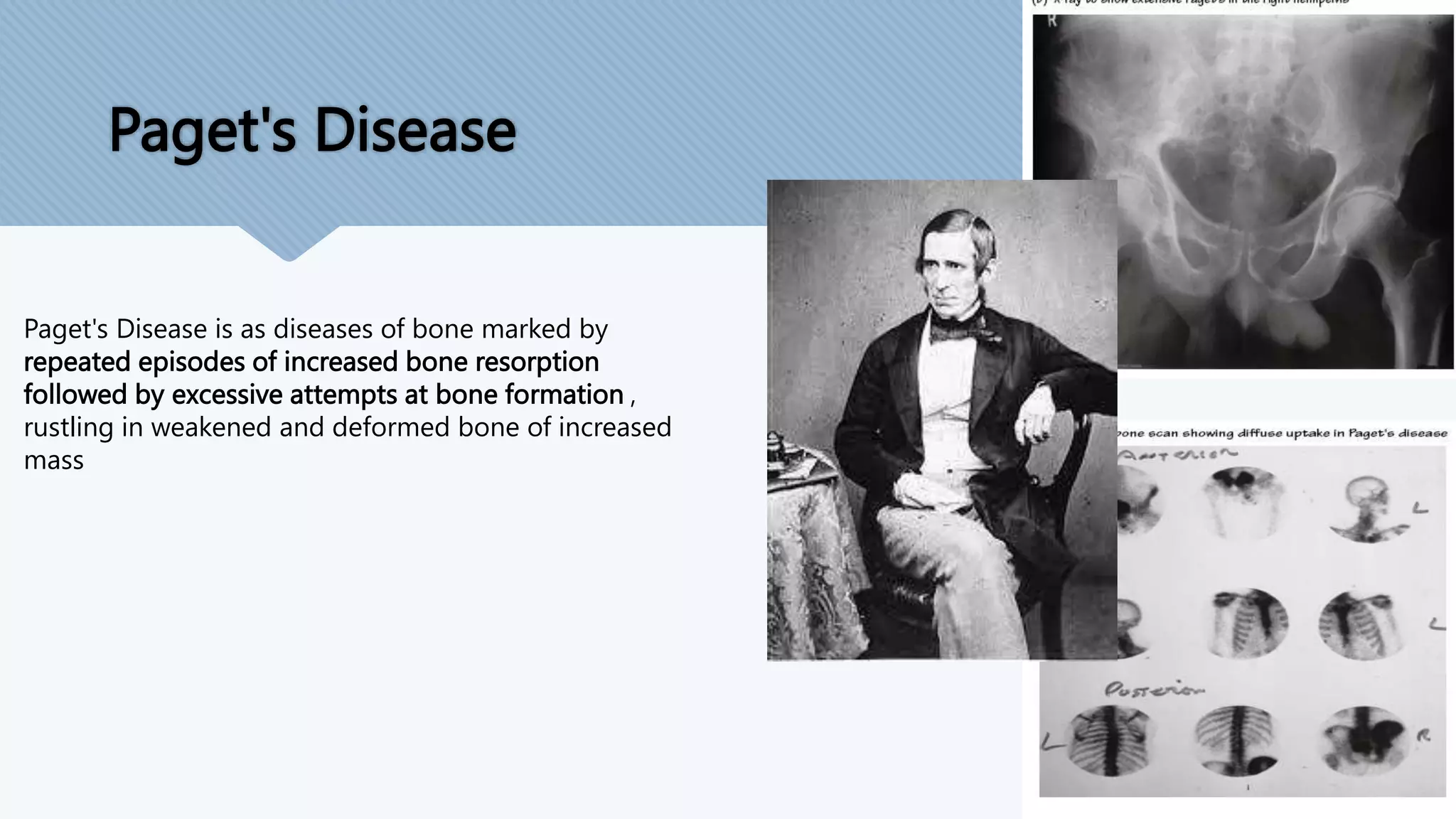 Paget's Disease | PPTX