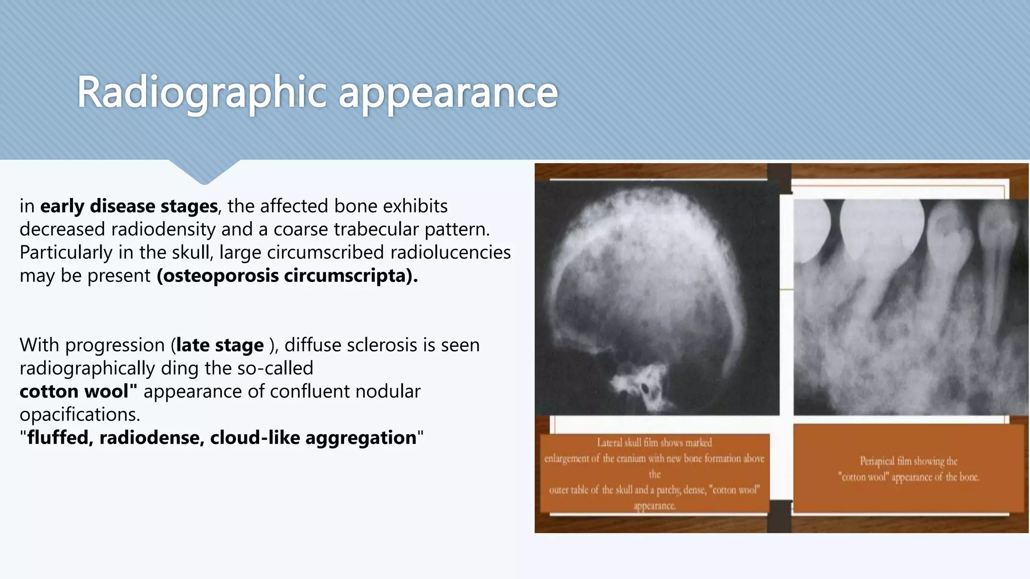 Paget's Disease | PPTX