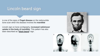Paget's Disease | PPTX