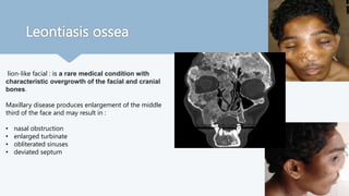 Paget's Disease | PPTX