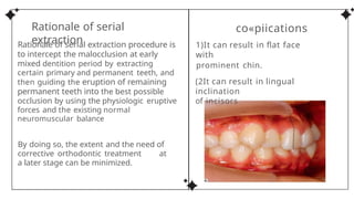Serial exctraction in orthodontic treatment.pptx