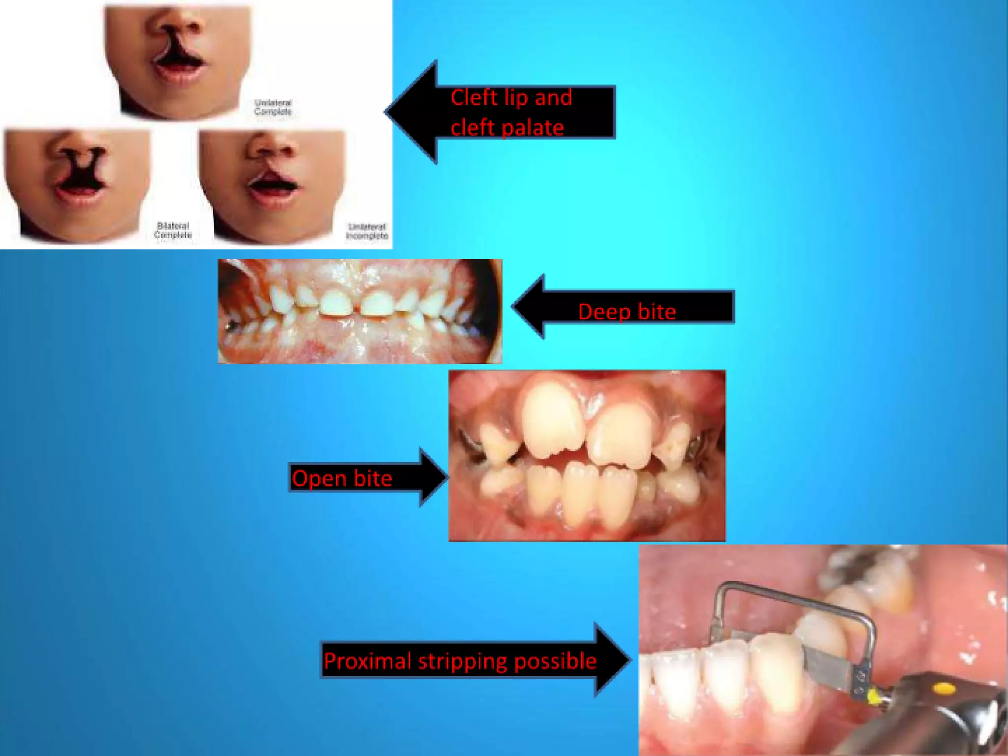 Serial extraction | PPT