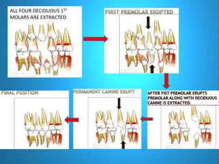 Serial extraction | PDF