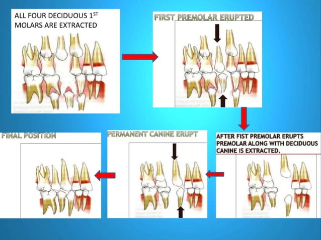 Serial extraction | PPT