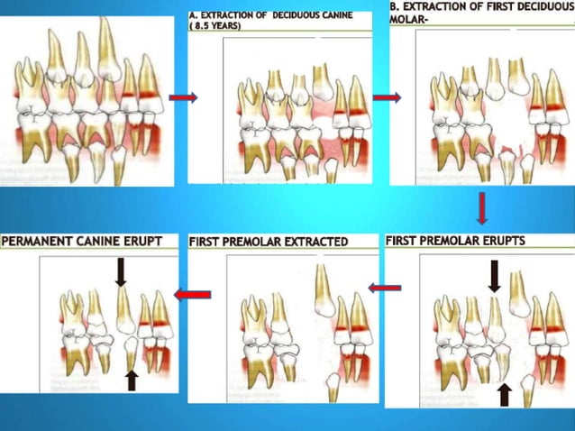 Serial extraction | PPT