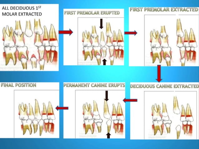 Serial extraction | PPT