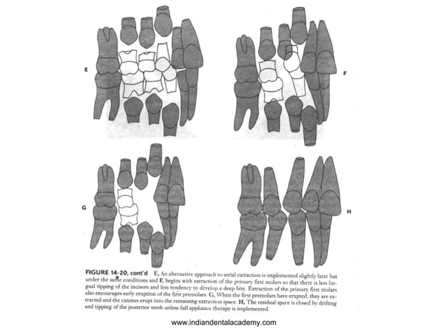 Serial extraction | PPT | Dental Health | Diseases and Conditions