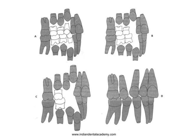 Serial extraction | PPT | Dental Health | Diseases and Conditions