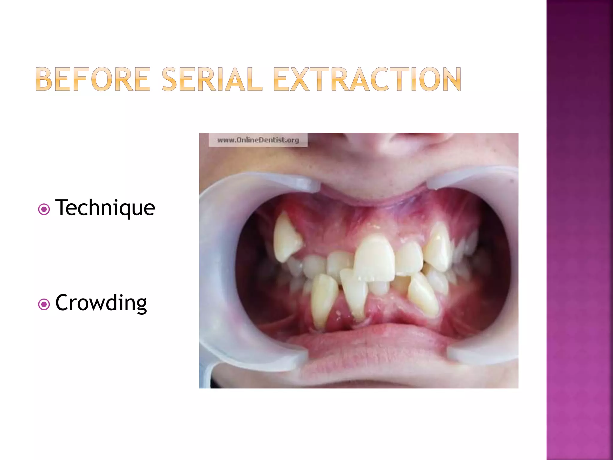 Serial extraction | PPTX