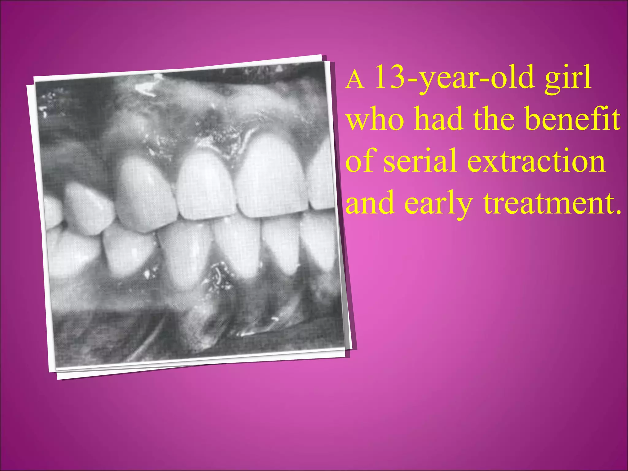 Serial extraction in orthodontic | PPT