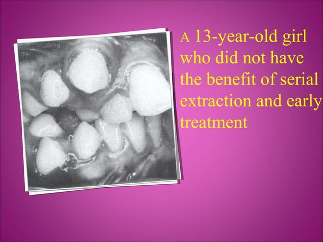 Serial extraction in orthodontic | PPT | Dental Health | Diseases and ...