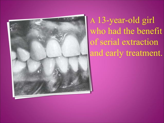 Serial extraction in orthodontic | PPT | Dental Health | Diseases and ...