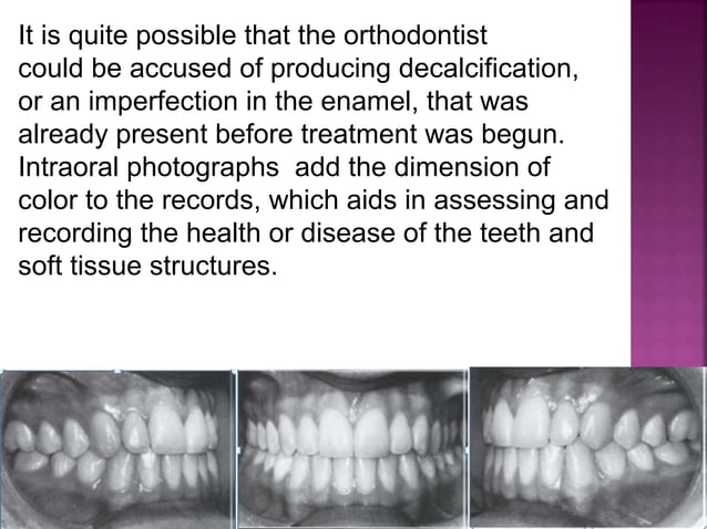 Serial extraction in orthodontic | PPT | Dental Health | Diseases and ...