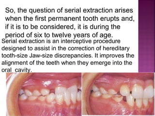 Serial extraction in orthodontic | PPT