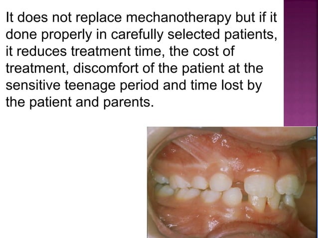 Serial extraction in orthodontic | PPT | Dental Health | Diseases and ...