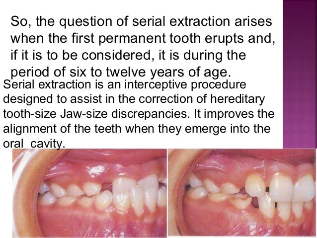 Serial extraction in orthodontic