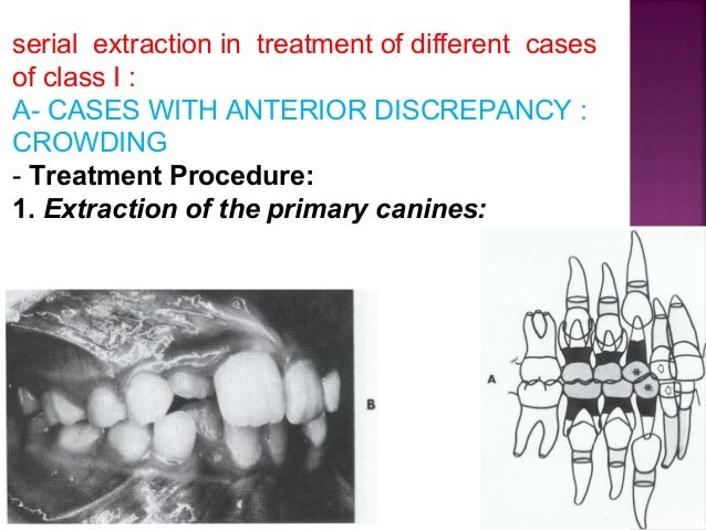 Serial Extraction Of Primary Teeth Technique - revizionmovies