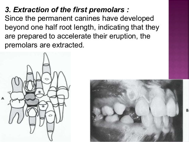Serial extraction in orthodontic