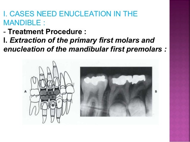 Serial extraction in orthodontic