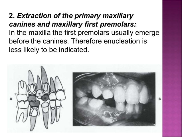 Serial extraction in orthodontic