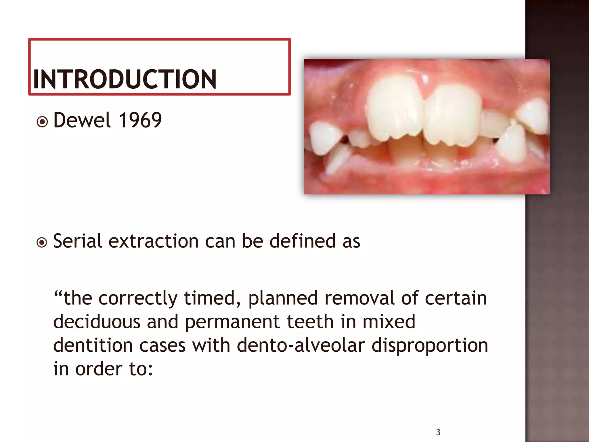 Serial extraction | PPTX