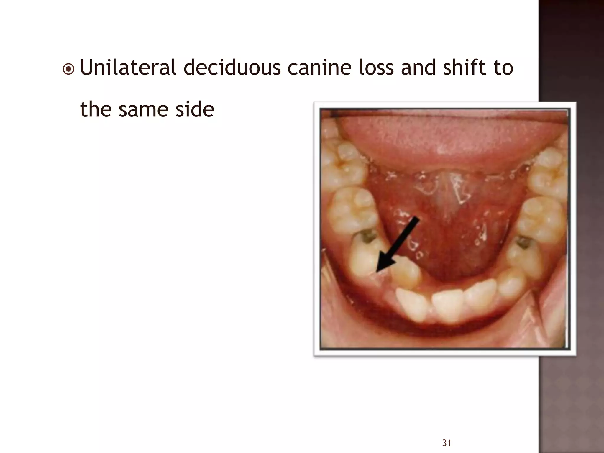 Serial extraction | PPTX