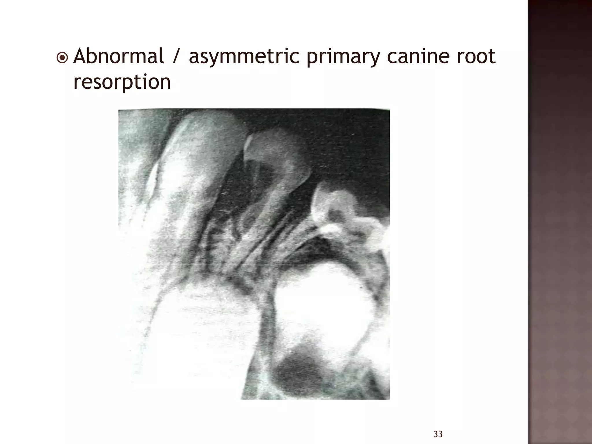 Serial extraction | PPTX