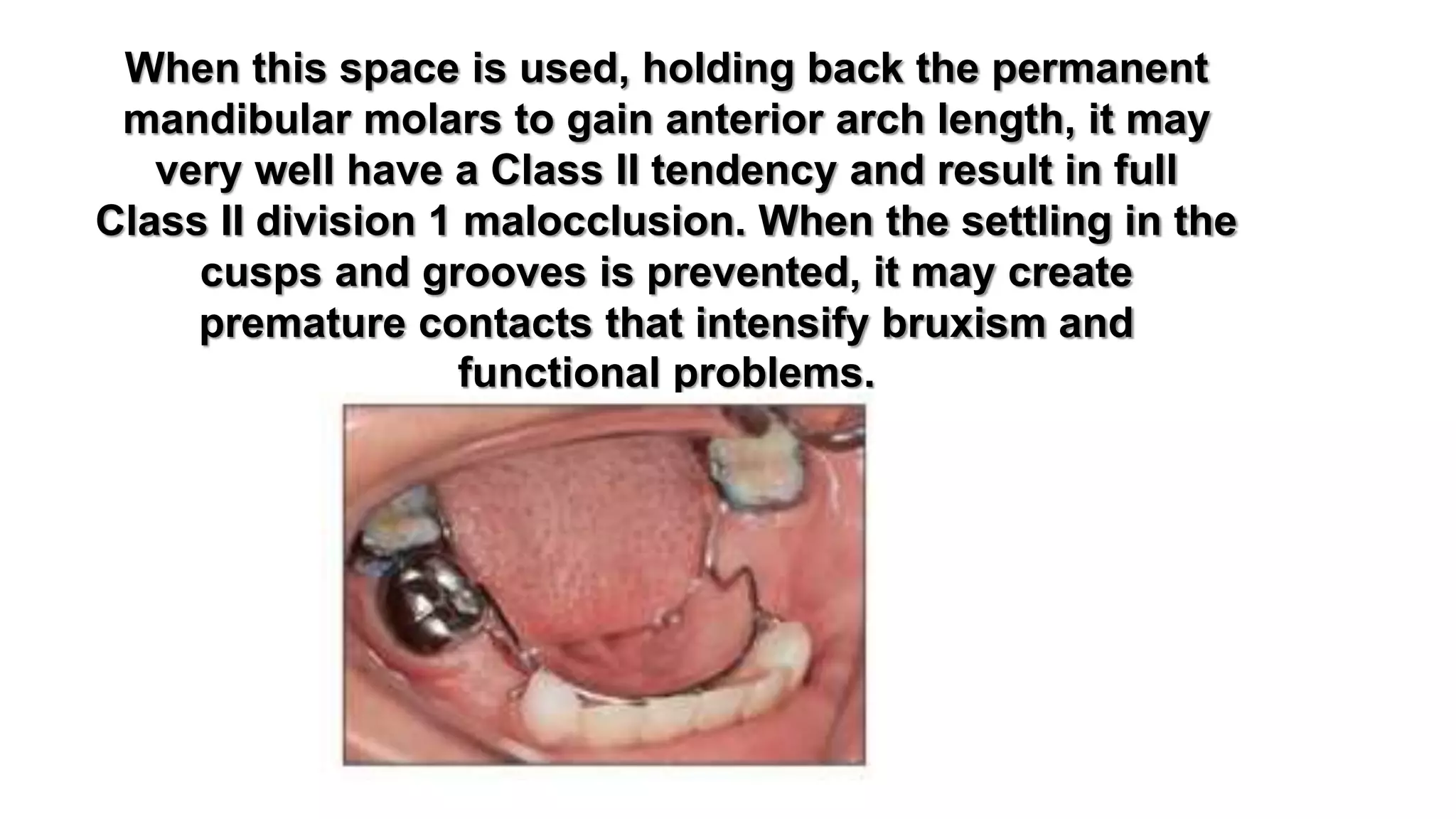 Serial extraction of class i malocclusion | PPTX
