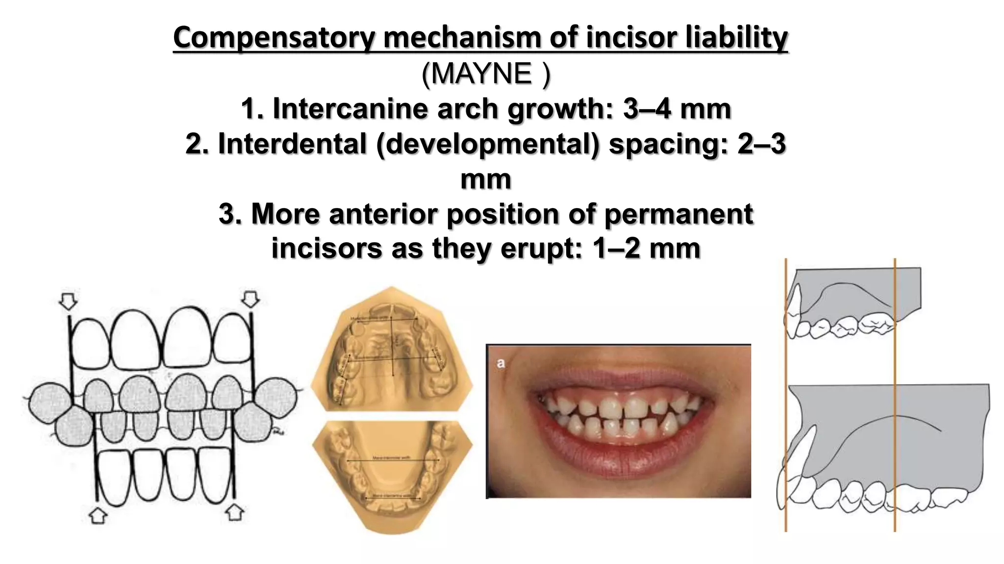 Serial extraction of class i malocclusion | PPTX