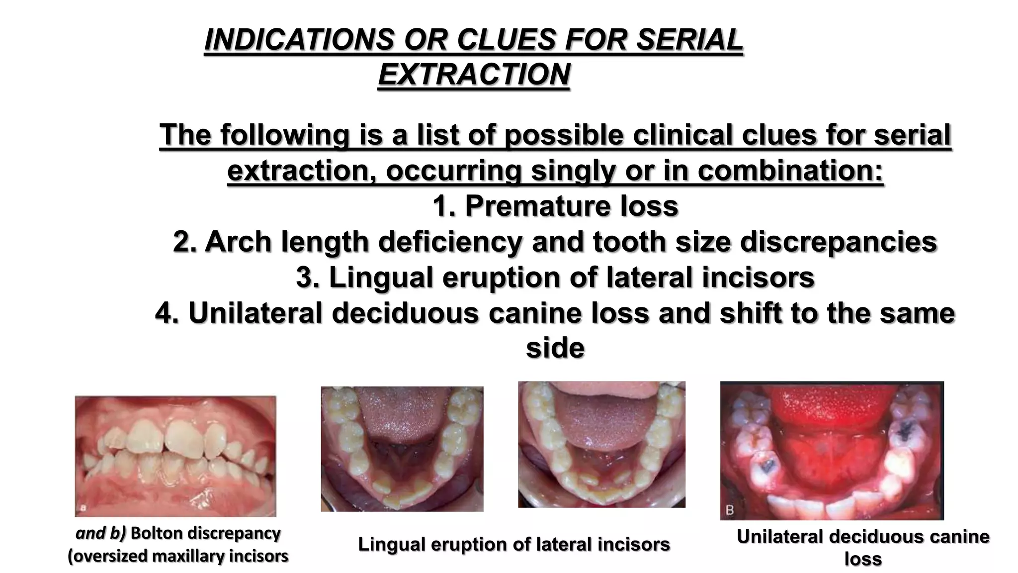Serial extraction of class i malocclusion | PPTX | Dental Health ...