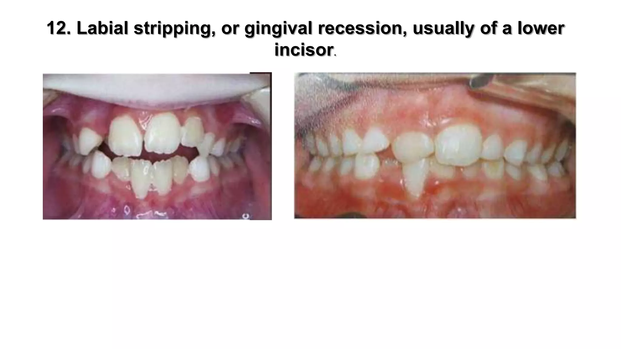 Serial extraction of class i malocclusion | PPTX