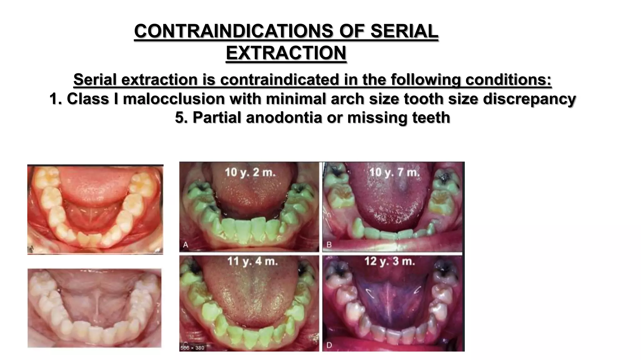 Serial extraction of class i malocclusion | PPTX | Dental Health ...