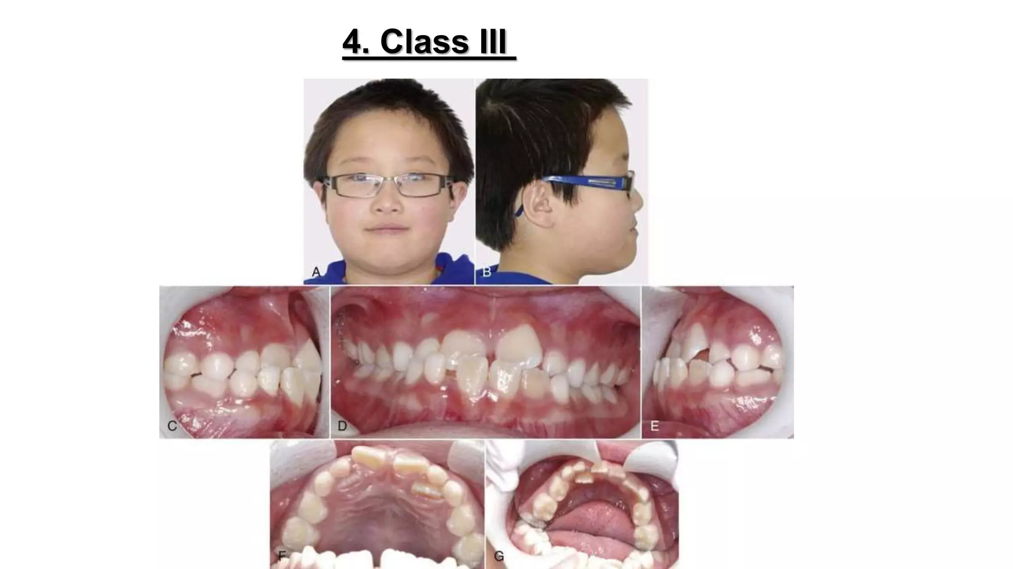Serial extraction of class i malocclusion | PPTX