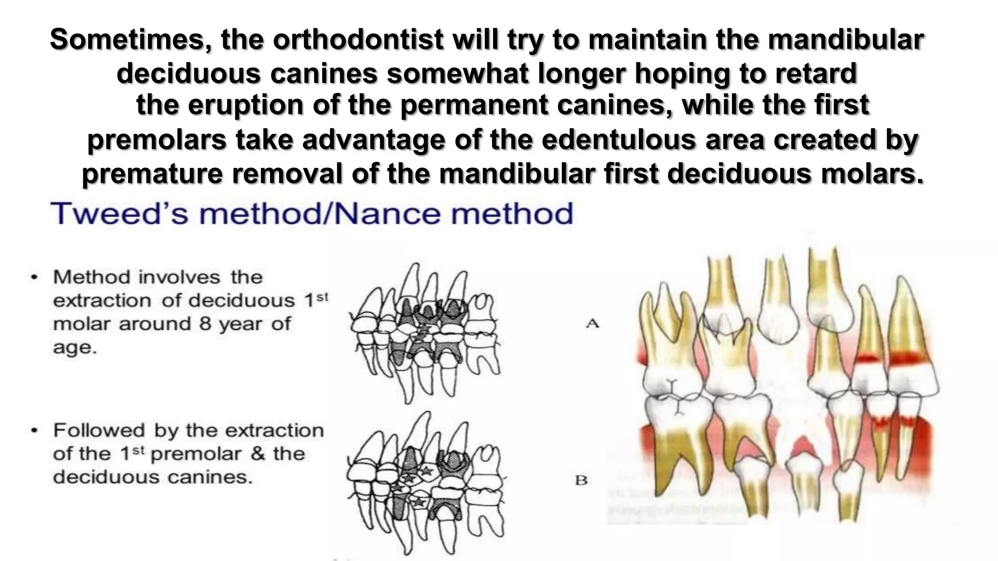 Serial extraction of class i malocclusion | PPTX | Dental Health ...