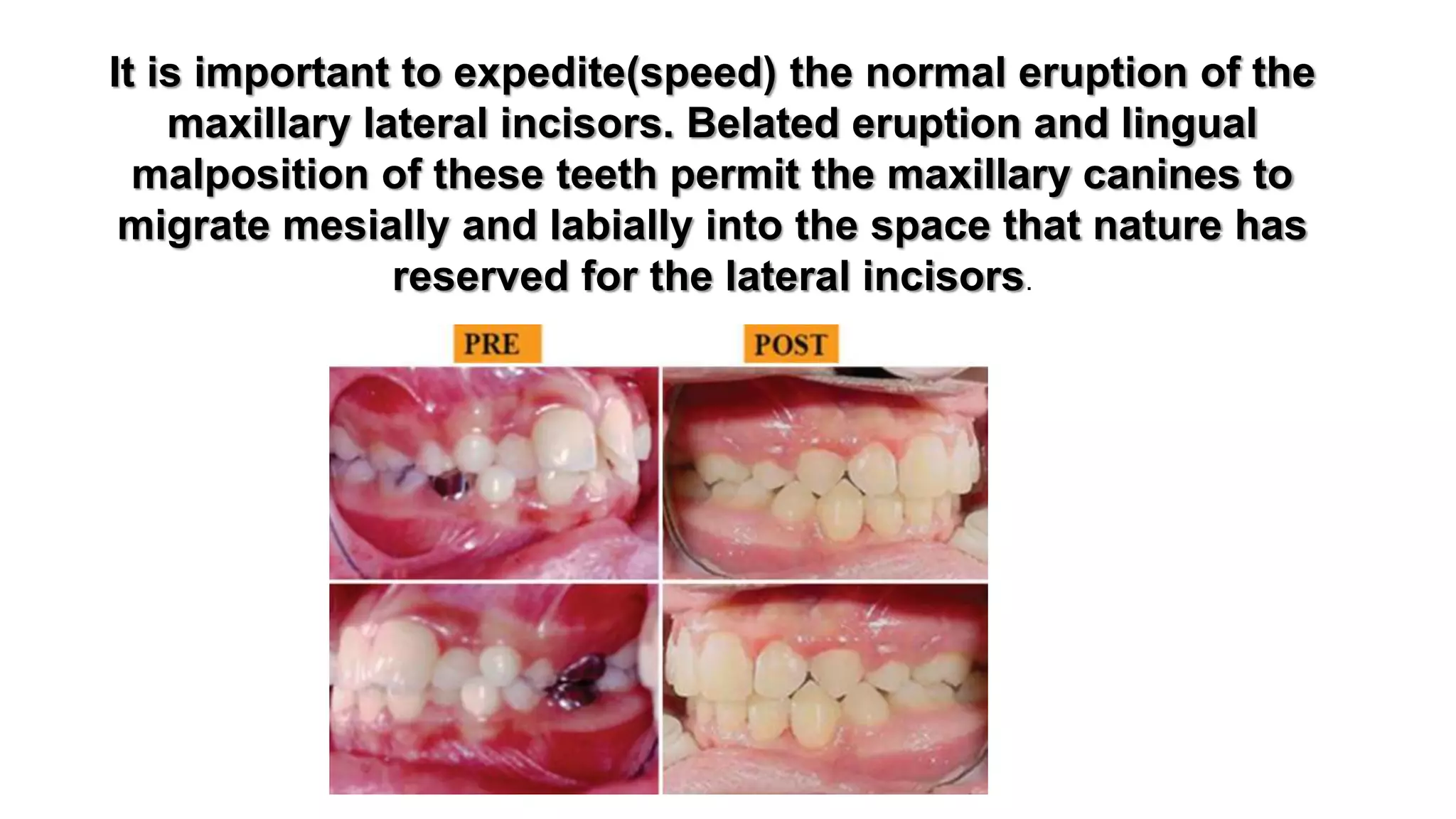 Serial extraction of class i malocclusion | PPTX