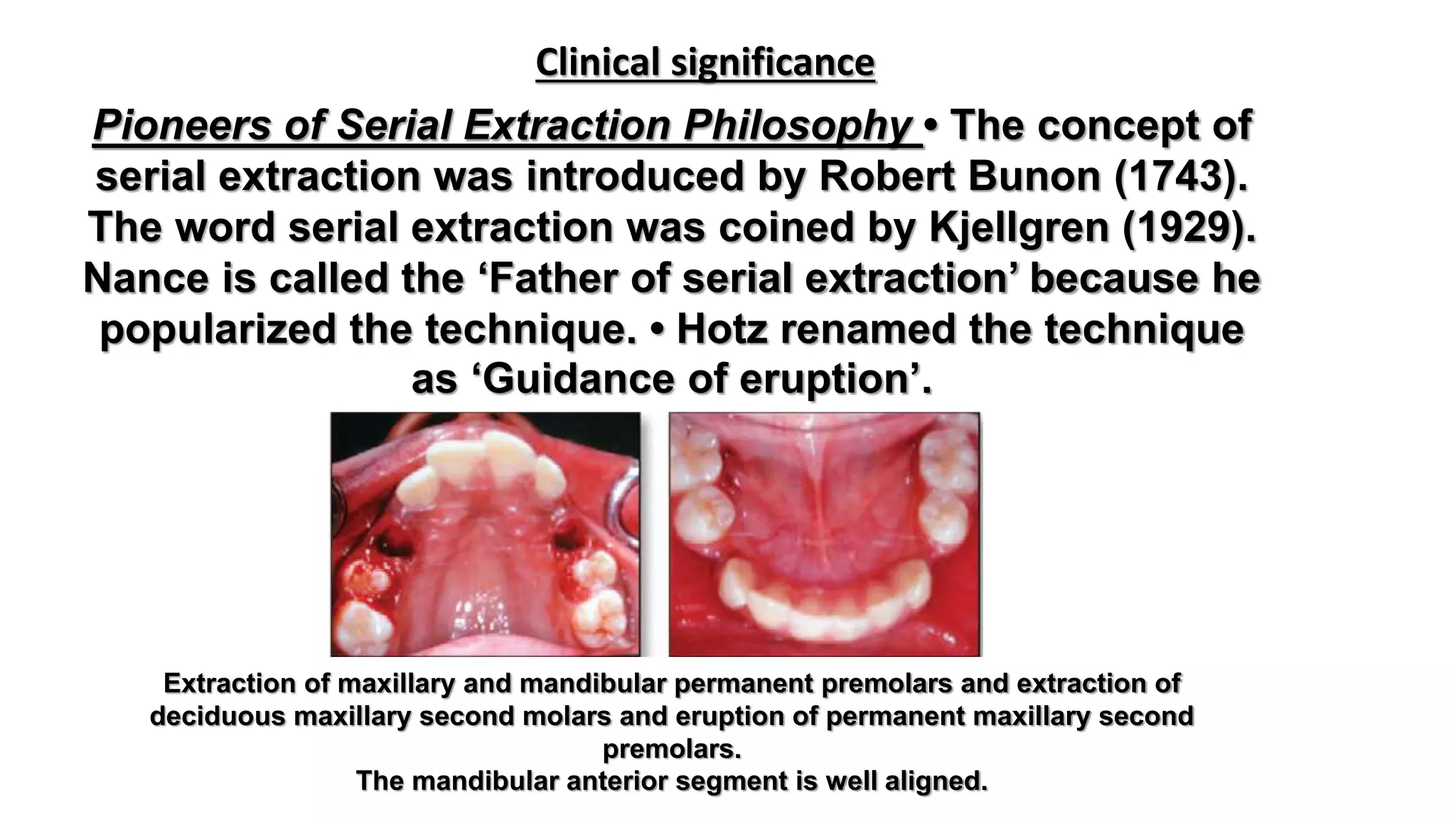 Serial extraction of class i malocclusion | PPTX