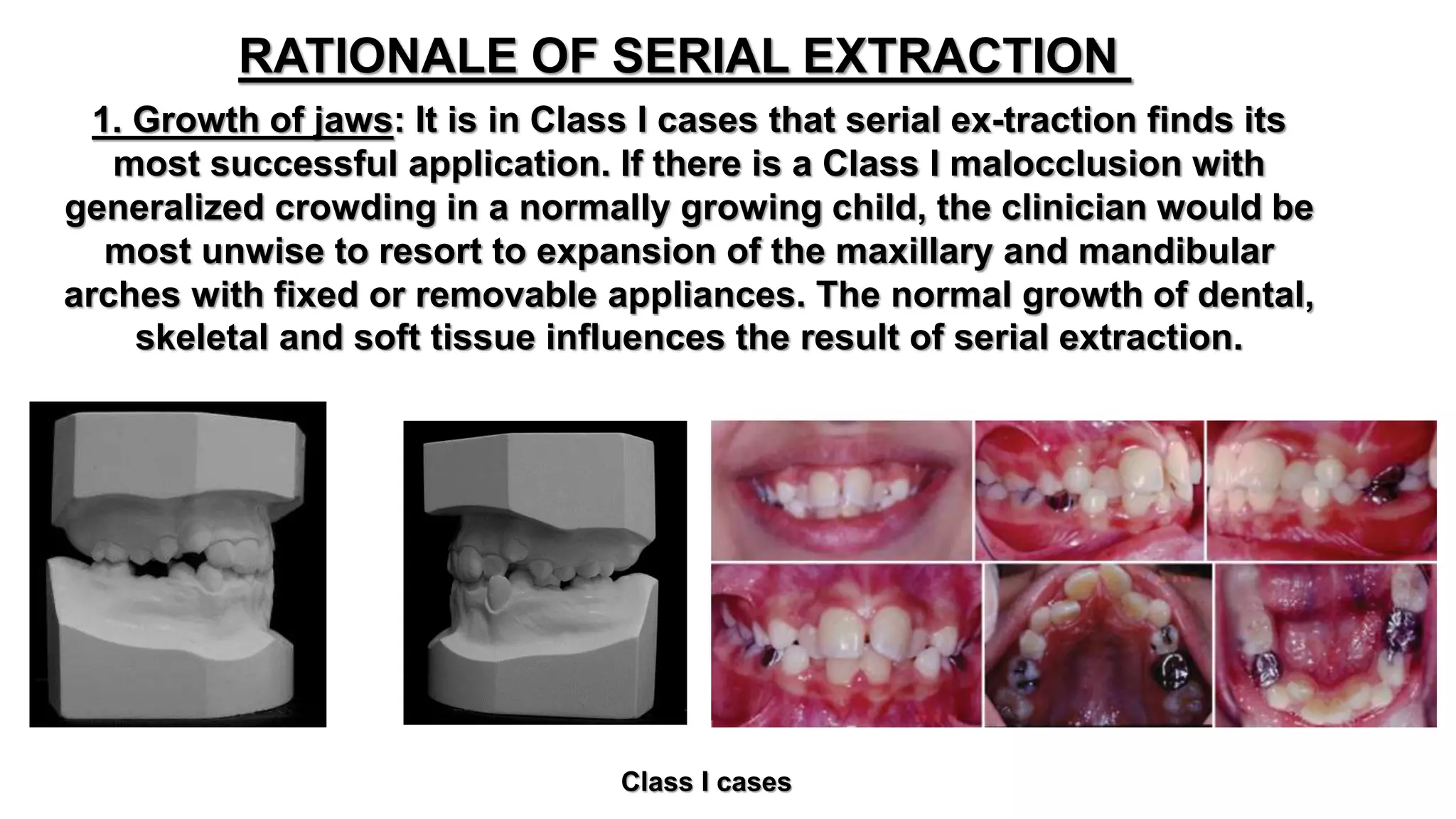 Serial extraction of class i malocclusion | PPTX