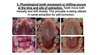 Serial extraction of class i malocclusion | PPTX