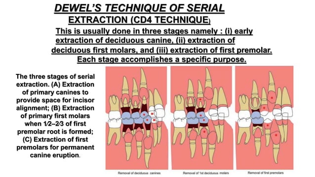 Serial extraction of class i malocclusion | PPTX | Dental Health ...