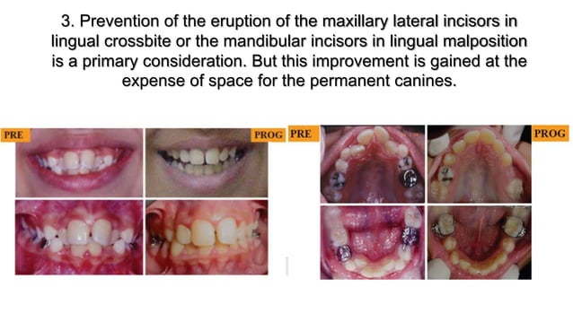 Serial extraction of class i malocclusion | PPTX | Dental Health ...