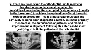 Serial extraction of class i malocclusion | PPTX