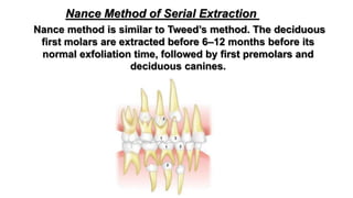 Serial extraction of class i malocclusion | PPTX
