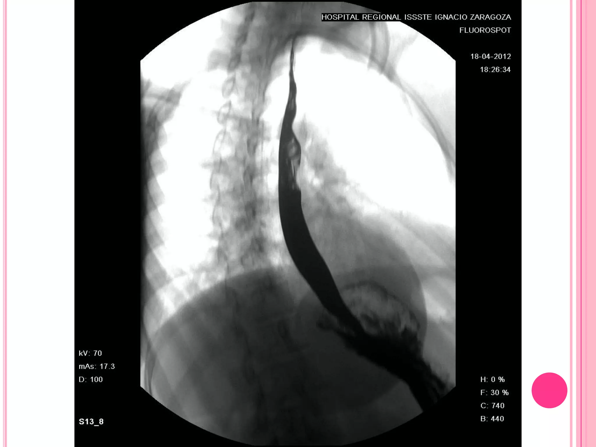 Serie esofagogastroduodenal | PPTX | Digestive Disorders | Diseases and ...