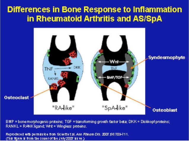 SERO-NEGATIVE ARTHRITIS | PPTX | Bone and Joint Conditions | Diseases ...