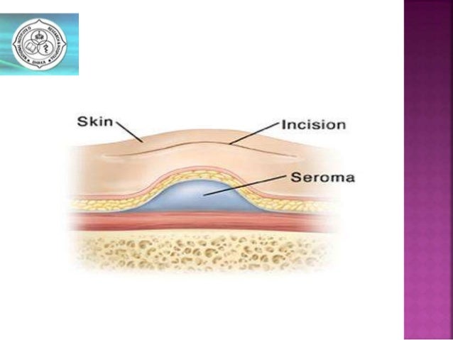 Seroma presentation