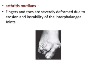 Seronegative Arthropathy.pptx